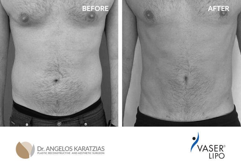 Vaser 3D Lipo | Ultrasound liposuction and fat sculpting | Cyprus